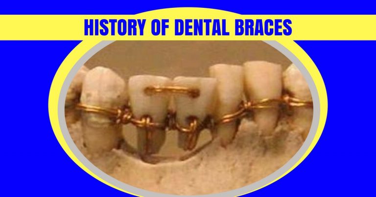 A Peek into the History of Braces - Expert Dental Care