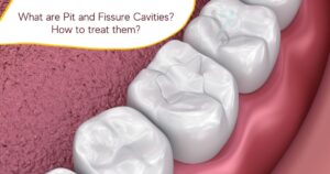 What are Pit and Fissure Cavities and how to treat them?